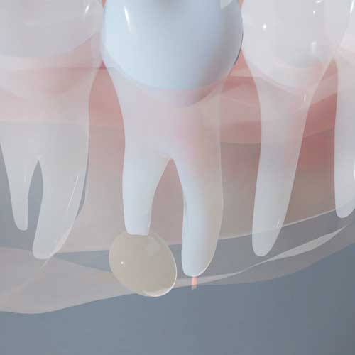 The Truth About Tooth Infections - Turtle Creek Dental Associates